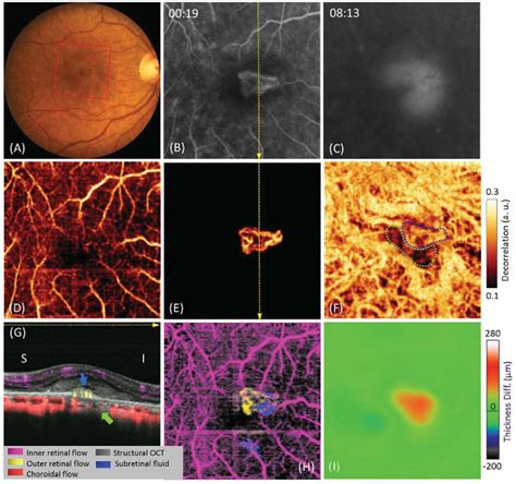 Figure 1 From Quantitative Optical Coherence Tomography Angiography Of Choroidal