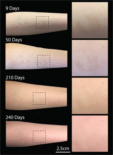Postinflammatory Hyperpigmentation After Human Cold Pain Testing Pmc