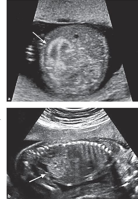 Hyperechoic Ultrasound