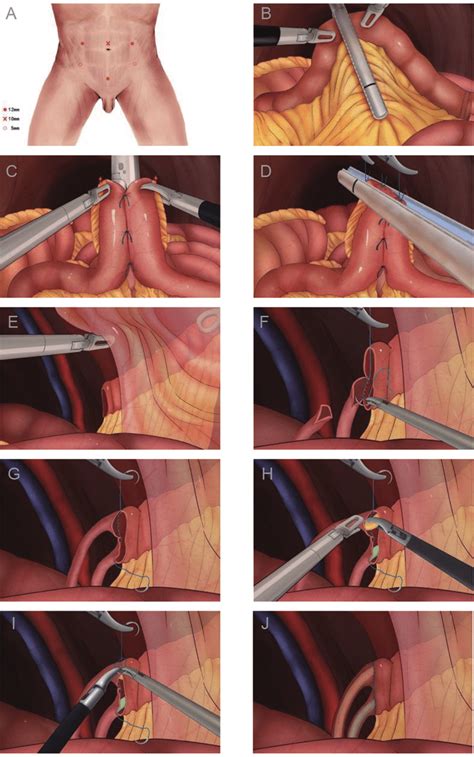 Procedures For Intracorporeal Ileal Conduit Urinary Diversion Download Scientific Diagram