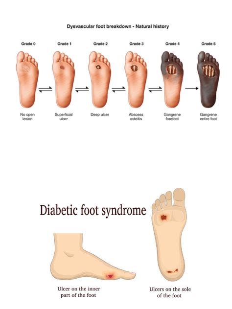Pictures Of Diabetic Amputations Pdf