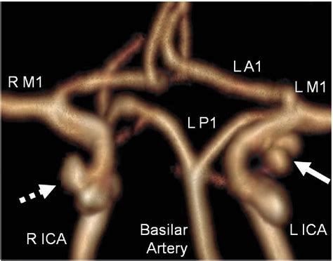 Figure 1 From Non Contrast 3d Time Of Flight Magnetic Resonance Angiography For Visualization Of