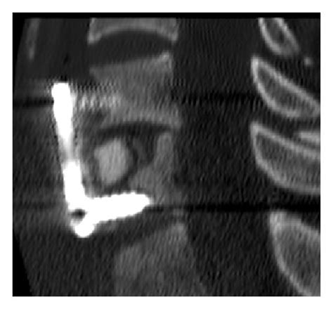 A B And C Postoperative Ct Scan Demonstrating A Good Download Scientific Diagram