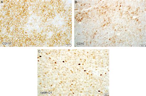 Immunohistochemical Findings Of Metastatic Sarcoma In The Lung The Download Scientific Diagram