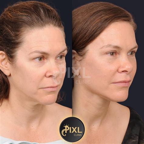 Neck Liposuction Before And After Pixl Clinic