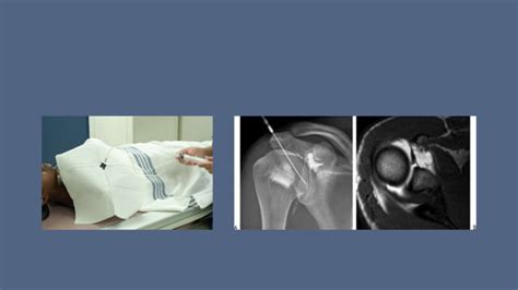 Radiographic Procedure Arthogram Pptx