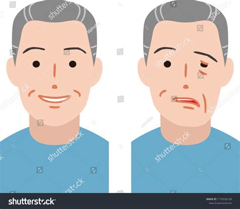 Stroke Face Paralysis