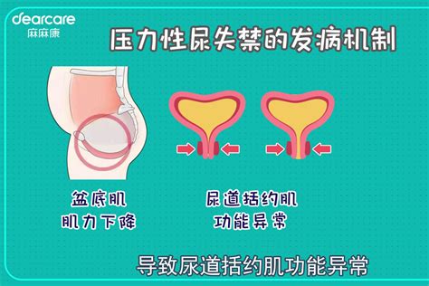 为什么产后修复好之后还会漏尿打喷嚏咳嗽可能是这个原因导致的 凤凰网视频 凤凰网