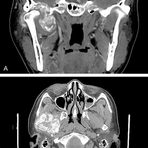 Pdf Digital Resection And Reconstruction Of Tmj Synovial Chondrosarcoma Involving The Skull