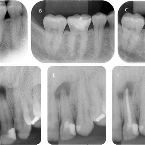 Flowchart Sequence Of The Patients Selection For Endodontic Treatment Download Scientific