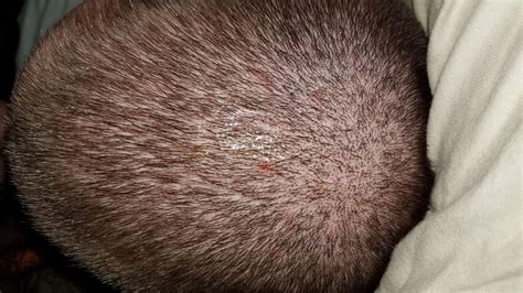 Pimples On Head Scalp My XXX Hot Girl