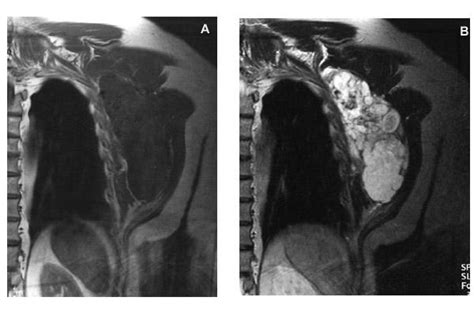 Chondrosarcoma Of The Scapula Eurorad