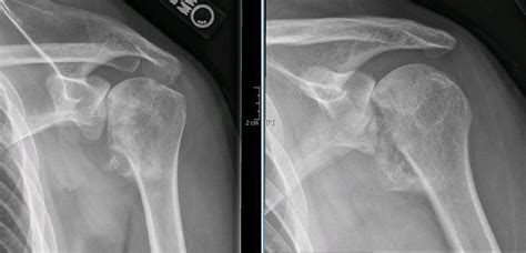 Proximal Humerus Fractures Trauma Orthobullets Com