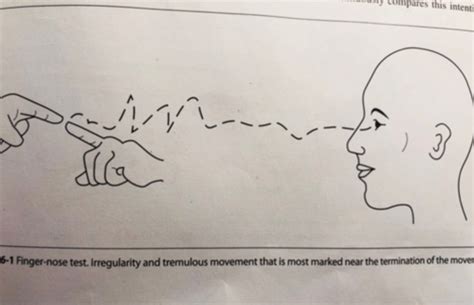 Tremor Differential Diagnosis Flashcards Quizlet