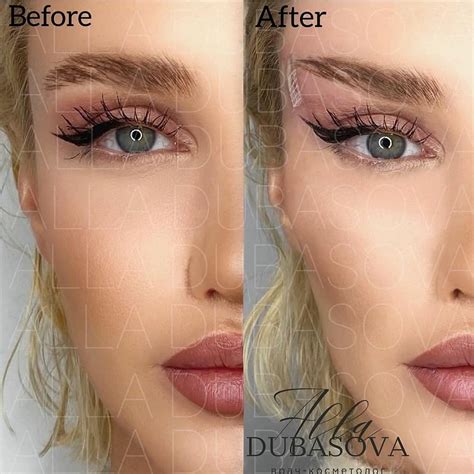 Cat Eye Thread Lift Procedure Mario Meadows