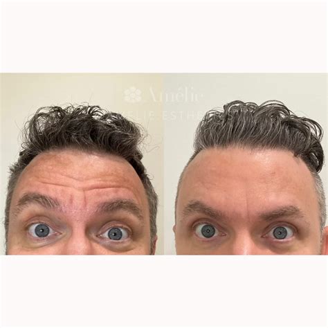 Unlocking The Secrets To Prolonging Your Botox Results Amelie Med Spa