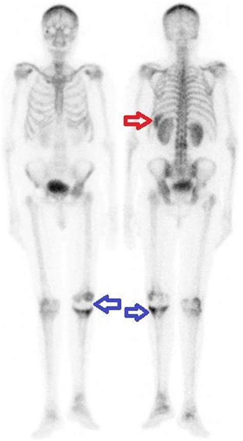 Spleen Uptake In Sickle Cell Anemia On Bone Scan Journal Of Nuclear