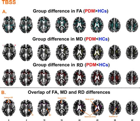 Tbss Findings A Regions Showing Increased Fa Fig 2a First Row