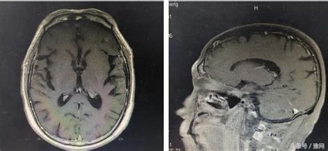 鄭州市第三人民醫院：控制肺癌腦轉移，幫助患者重獲生活自理能力 每日頭條
