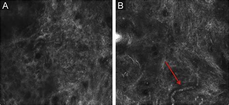 The Skin Through Reflectance Confocal Microscopy — Historical