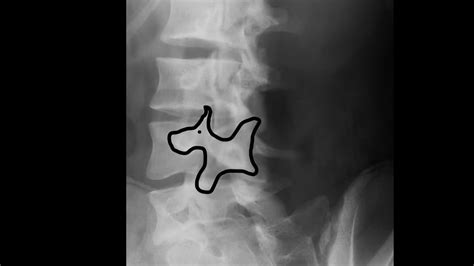 Lumbar X Ray Interpretation Osce Guide Radiology Geeky Medics