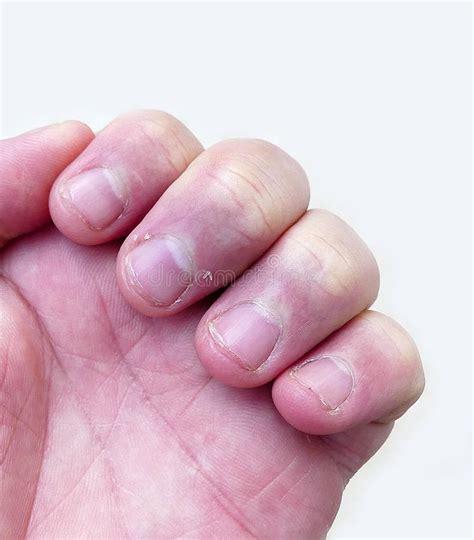 Zinc Deficiency Symptoms Nails