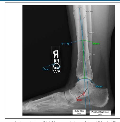 Figure 1 From Distal Tibia Apex Posterior Angulation A Normal Anatomic Variant Related To
