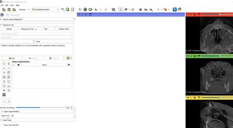 Dentalsegmentator Version Of 2024 04 22 Fails To Load Segmentation
