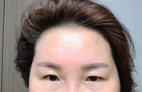 대구 리프트성형외과 강남언니