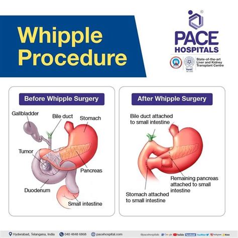 Whipple Procedure Anatomy