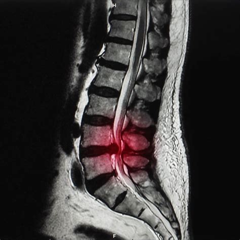 Top 7 Symptoms Of Spinal Stenosis Explained Vejthani