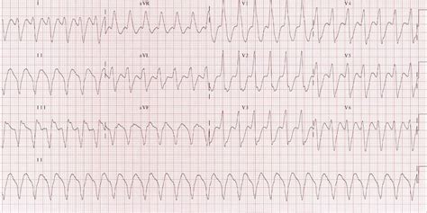 Ventricular Tachycardia Monomorphic Vt • Litfl • Ecg Library