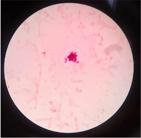 Gram Stain From The Blood Culture Showing Gram Positive Bacilli With