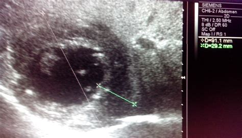 Киста В Печени На Узи Фото — Фото Картинки