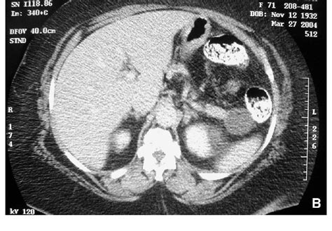 Figure 1 From Laparoscopic Distal Pancreatectomy With Splenic Preservation For Serous