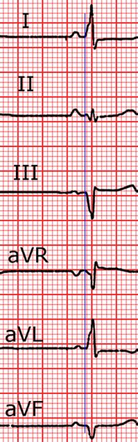Accessory Pathways Localization Arruda