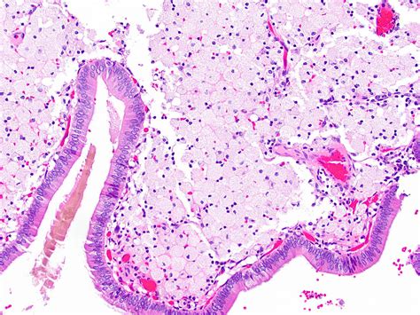 Hyperplastic Polyp Pathology Outlines Clinical Pathology Intestinal
