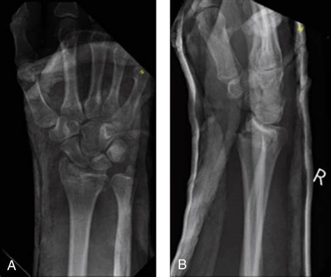 External Fixation Of Distal Radius Fractures Musculoskeletal Key