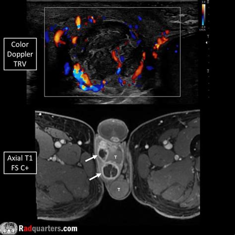 Right Epididymal Abscesses On Ultrasound And Mri Arrows R Radiology