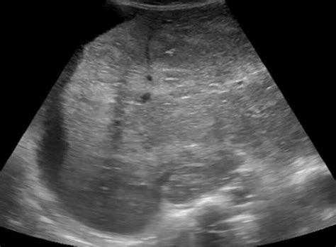 A Liver Ultrasonography Revealed Enlarged Liver With Heterogeneous Download Scientific Diagram