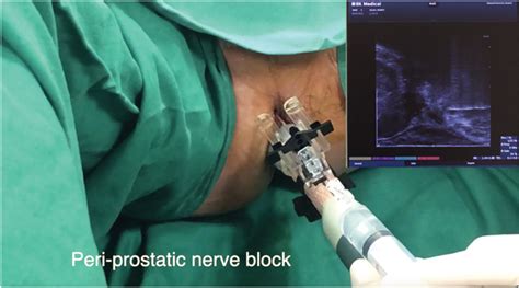 Injection Of Local Anaesthesia La As Periprostatic Nerve Block Download Scientific Diagram