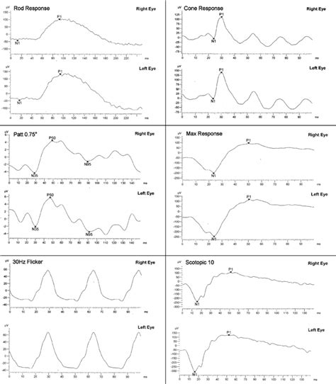 Pattern Erg And A Full Field Erg Of Patient 1 Pattern Erg Responses