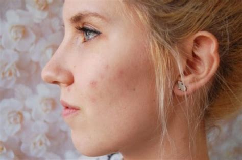 How To Remove Pimple Scars Naturally SheIdeas