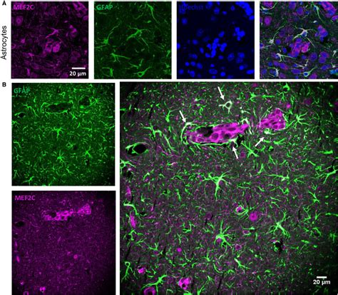 Myocyte Enhancer Factor 2c Mef2c Expression In The Peritumoral Download Scientific Diagram