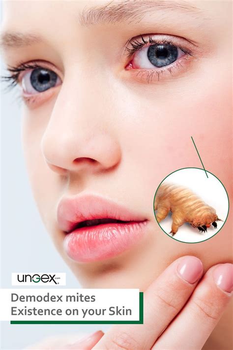 Demodex Mites Existence On Your Skin Artofit