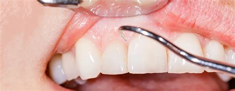 White Gums Causes Symptoms And Treatment Dentakay