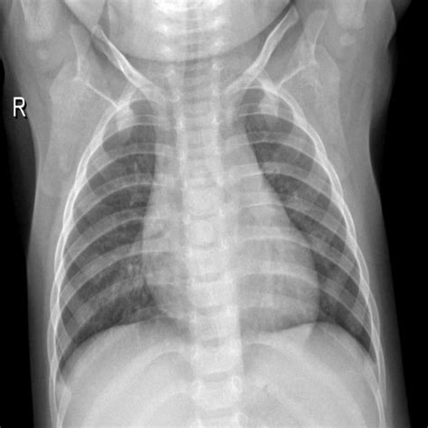trpakov vit chest x ray classification at main