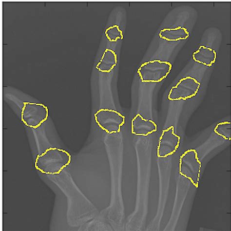 Rsna Bone Age Kaggle