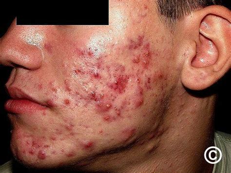 Acne Vulgaris