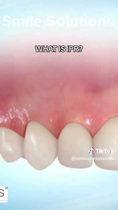 Ipr Interproximal Reduction Smoothing Between Teeth Makes Space To Align Teeth And Fix